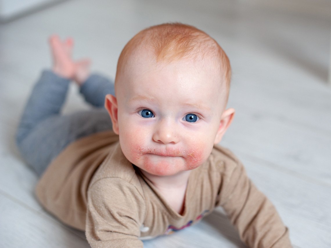 Las mejillas de mi bebé están rojas ¿Qué es la dermatitis atópica ...